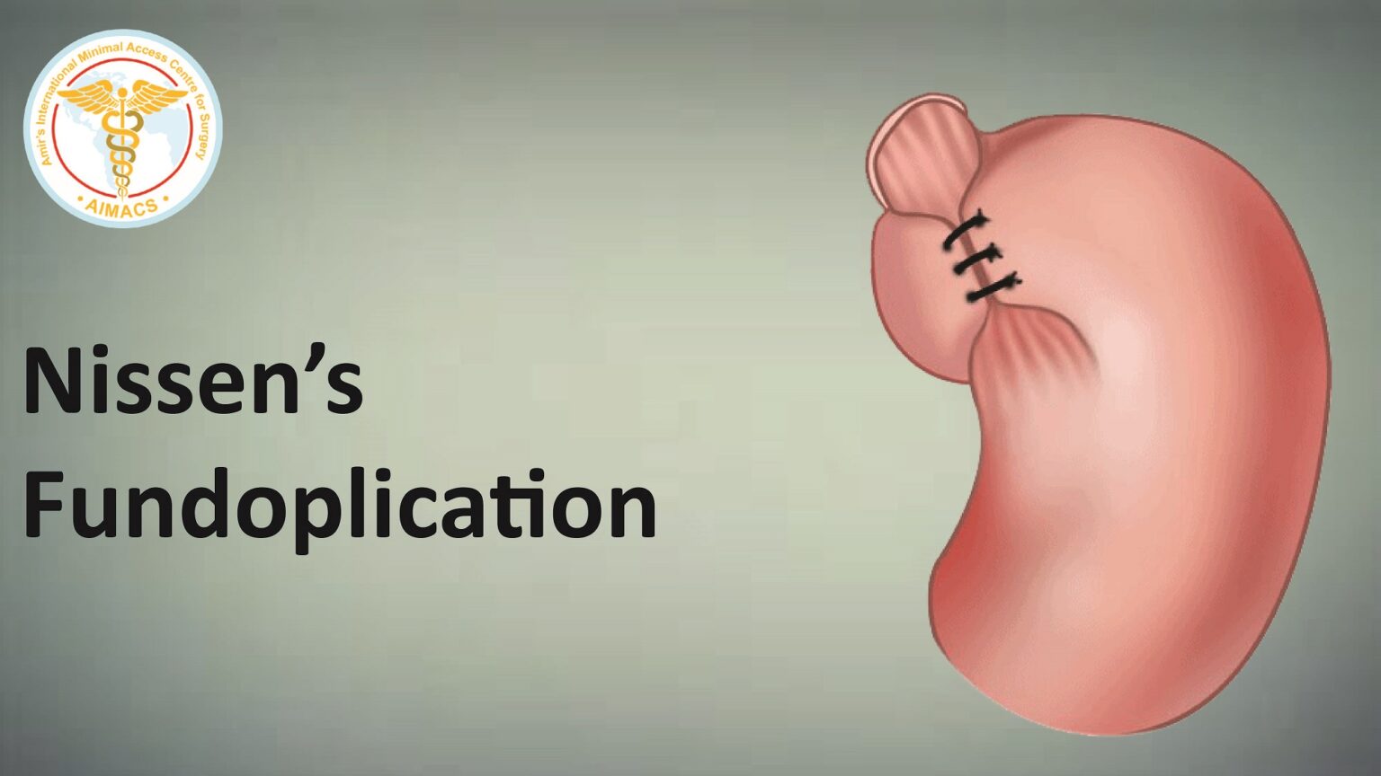 Recovery after Laparoscopic Nissen’s Fundoplication. What to expect ...