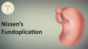 Recovery after Laparoscopic Nissen’s Fundoplication. What to expect ...