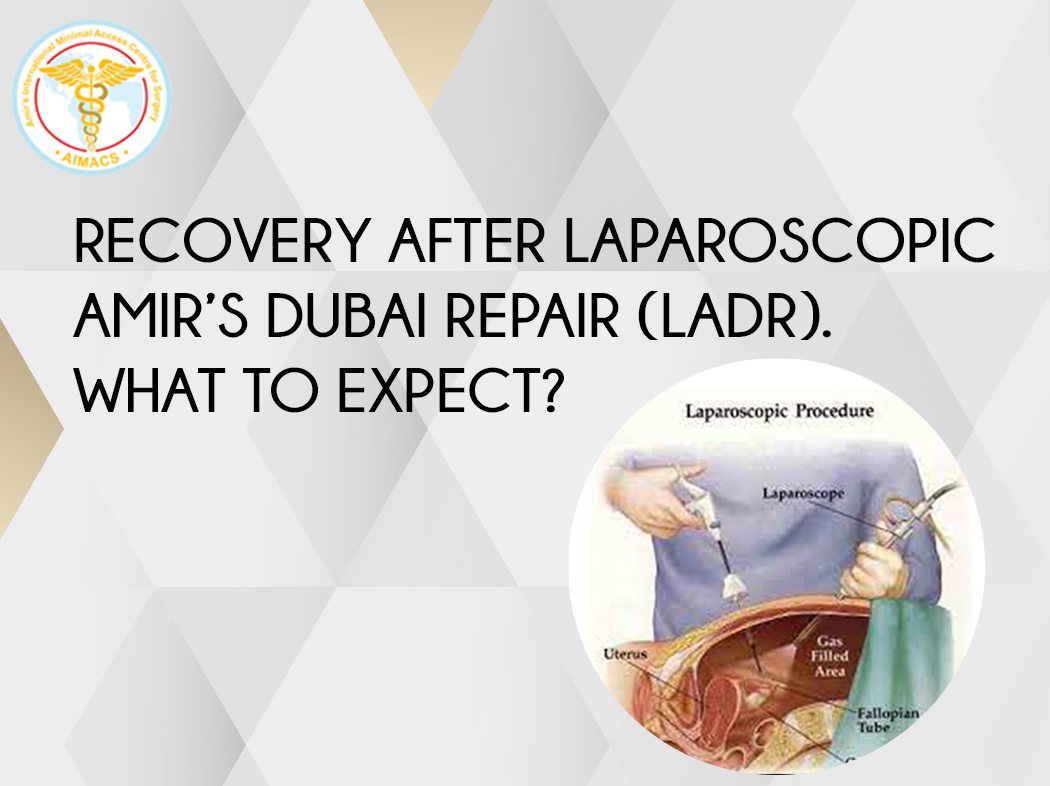 Recovery after Laparoscopic Amir’s Dubai Repair (LADR). What to expect ...