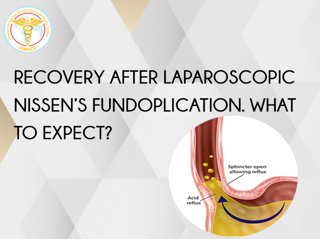 Recovery after Laparoscopic Nissen’s Fundoplication. What to expect ...