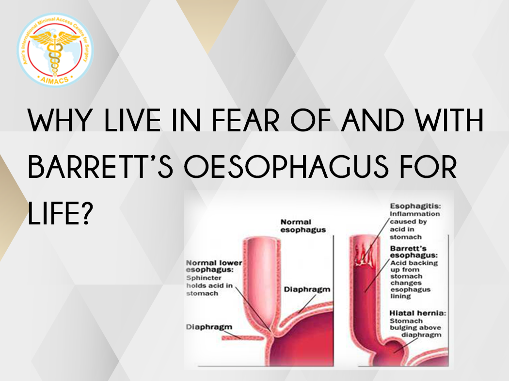 Why live in fear of and with Barrett’s Oesophagus for life? Prevention ...